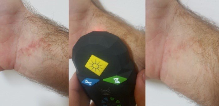 Treating Skin Conditions with coMra Therapy | coMra Therapy